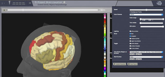 Researchers use patient data to simulate brain functions