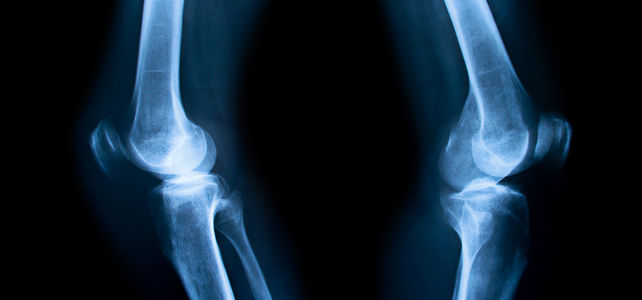 XLH - Symptoms and treatment